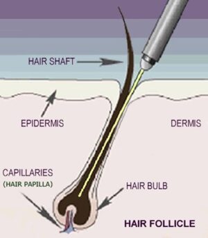 Electrolysis – Expert Electrolysis